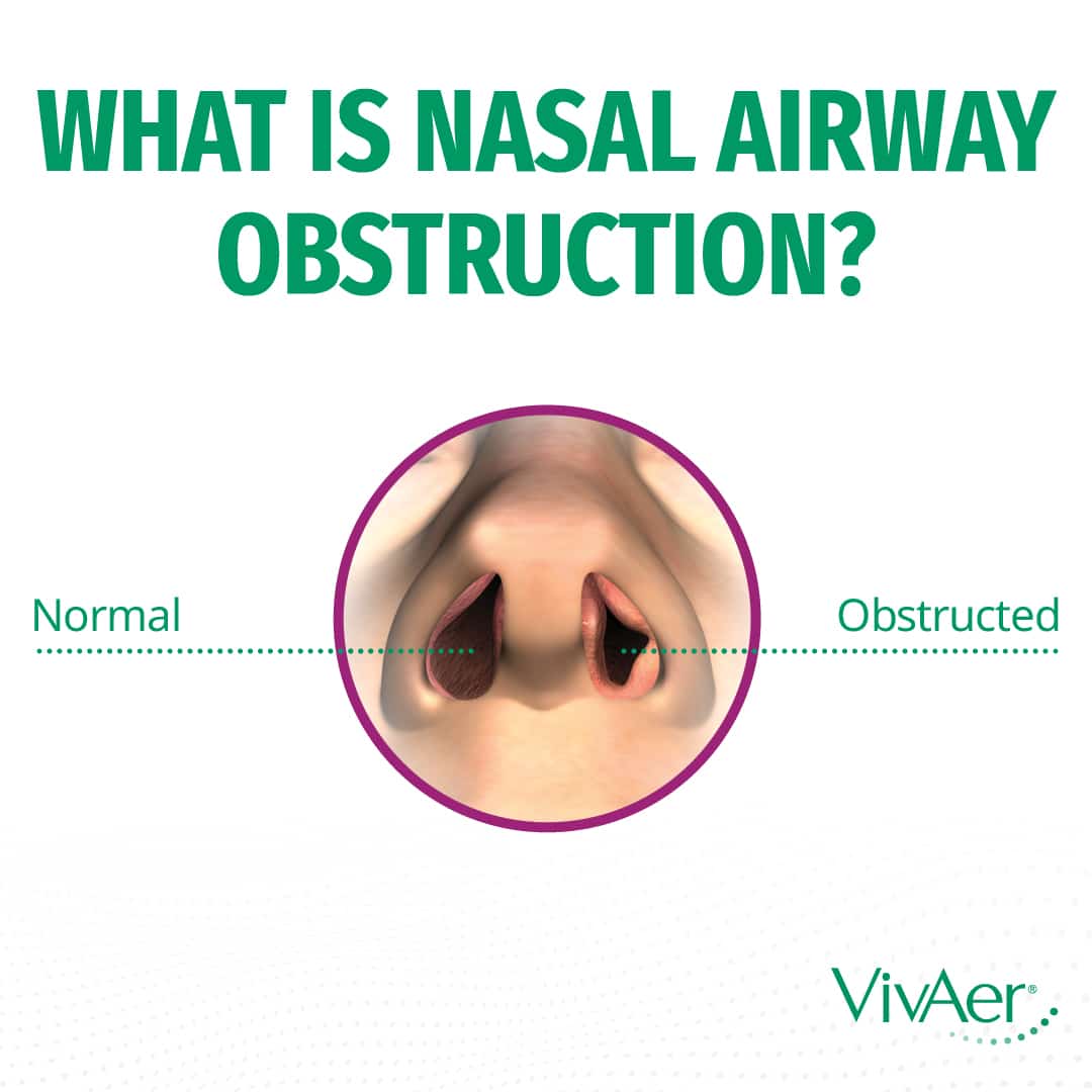 Nasal Obstruction Relief with Vivaer | Albany ENT & Allergy Services